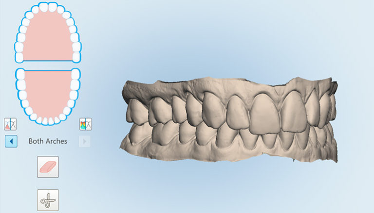 iTero Intra Oral Digital Scanner - Owen Orthodontics